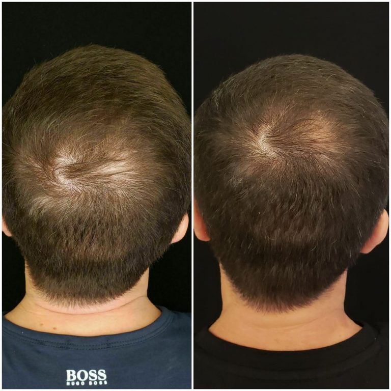 Prp Hair Restoration How Does It Work And Is It Permanent My Botox