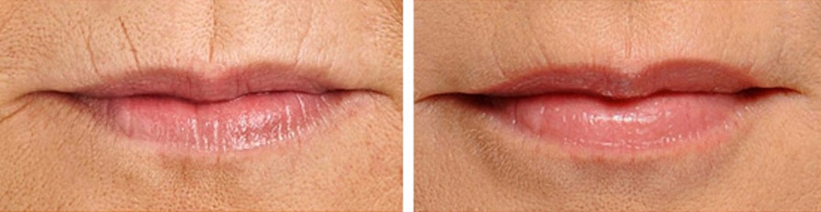 What Filler Is Best For Lip Lines Health Future Quotes