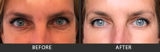 Belotero Before And After