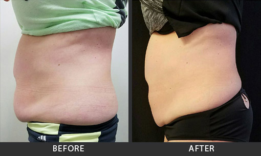 Coolsculpting Before And After Photos