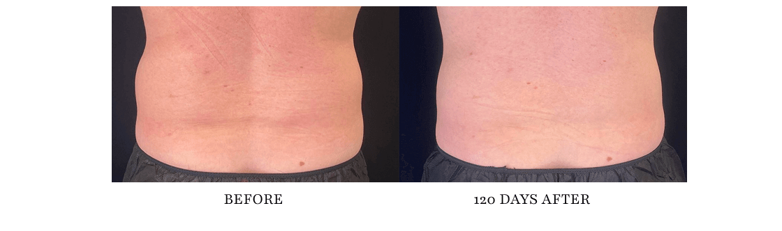 CoolSculpting in Los Angeles | Non-surgical Fat Reduction | MyBotoxLA